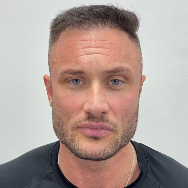 Patient Results - Page 2 of 2 - British Hair Clinic