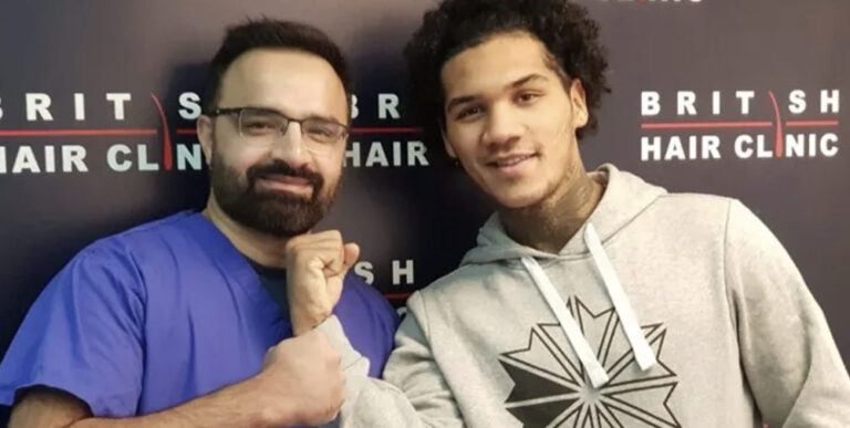 Conor Nigel Benn Beard Transplant Treatment - British Hair Clinic