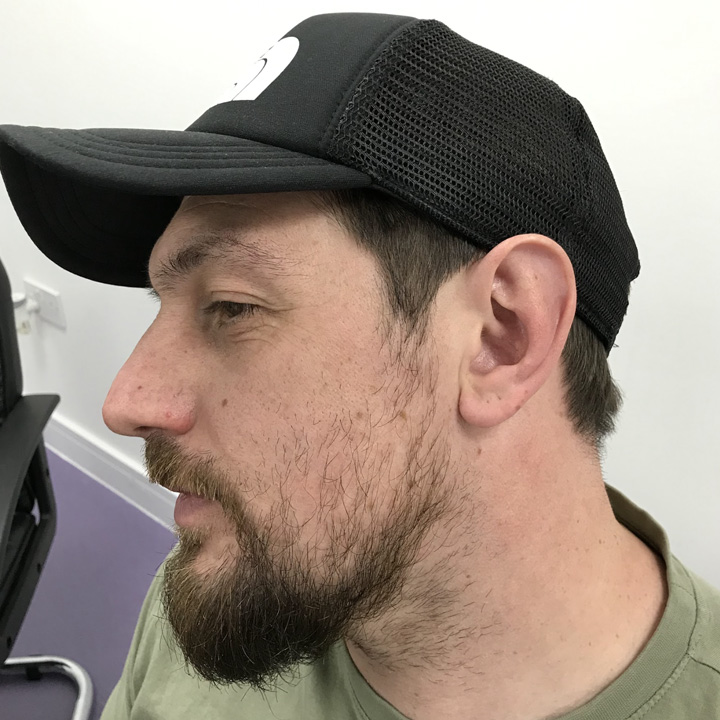 Patient Results - British Hair Clinic